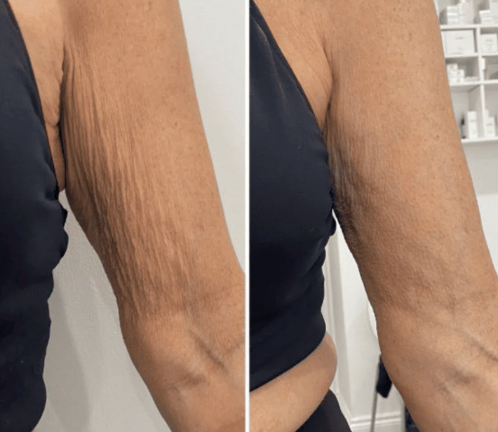 Dermocosmética Corporal Reafirmante - Combate Celulitis, Flacidez y Ar ...